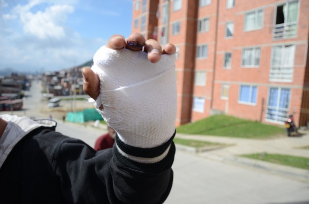 Lista de quemados en Caldas sigue en ascenso, van 22 lesionados